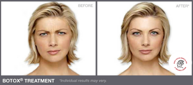 What Are The Key Advantages of Botox Treatment? | Health | Before It's News